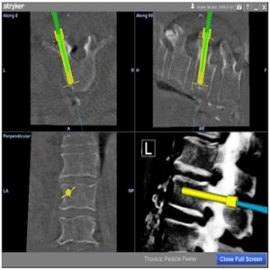 Computer Navigation - Advanced Spine treatment Technology